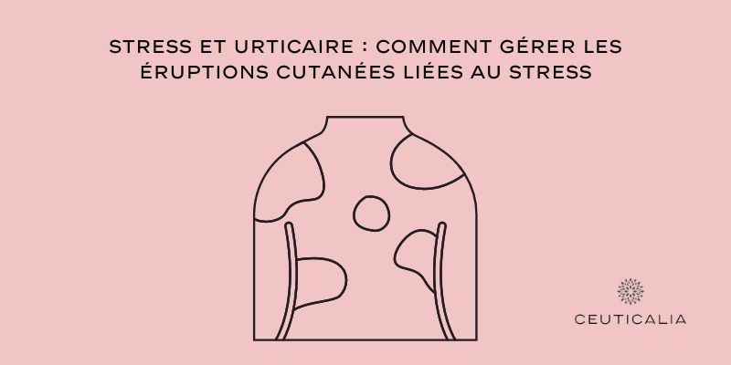 Gérer le stress pour soulager l'urticaire - Ceuticalia.com