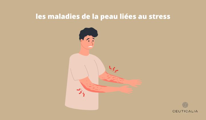 les maladies de la peau liées au stress - Ceuticalia.com
